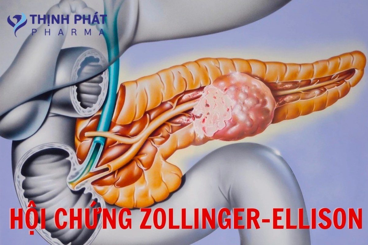Hội chứng Zollinger-Ellison là gì, có nguy hiểm không? - Dược Thịnh Phát